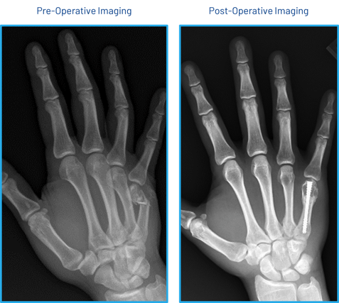 Use of NX Nail for oblique fracture fixation of 2nd metacarpal.